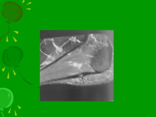 Overuse syndromes of Ankle joint .ppt