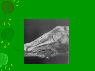 Overuse syndromes of Ankle joint .ppt