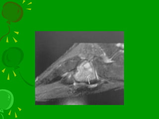Overuse syndromes of Ankle joint .ppt