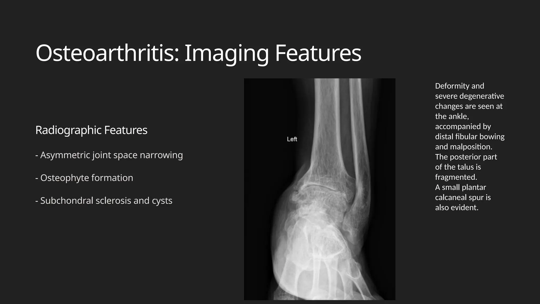 ANKLE PPT FINAL radiologist perspective .pptx