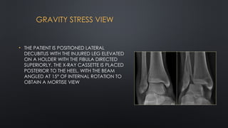 Radiological Features for Evaluation of the Ankle | PPT