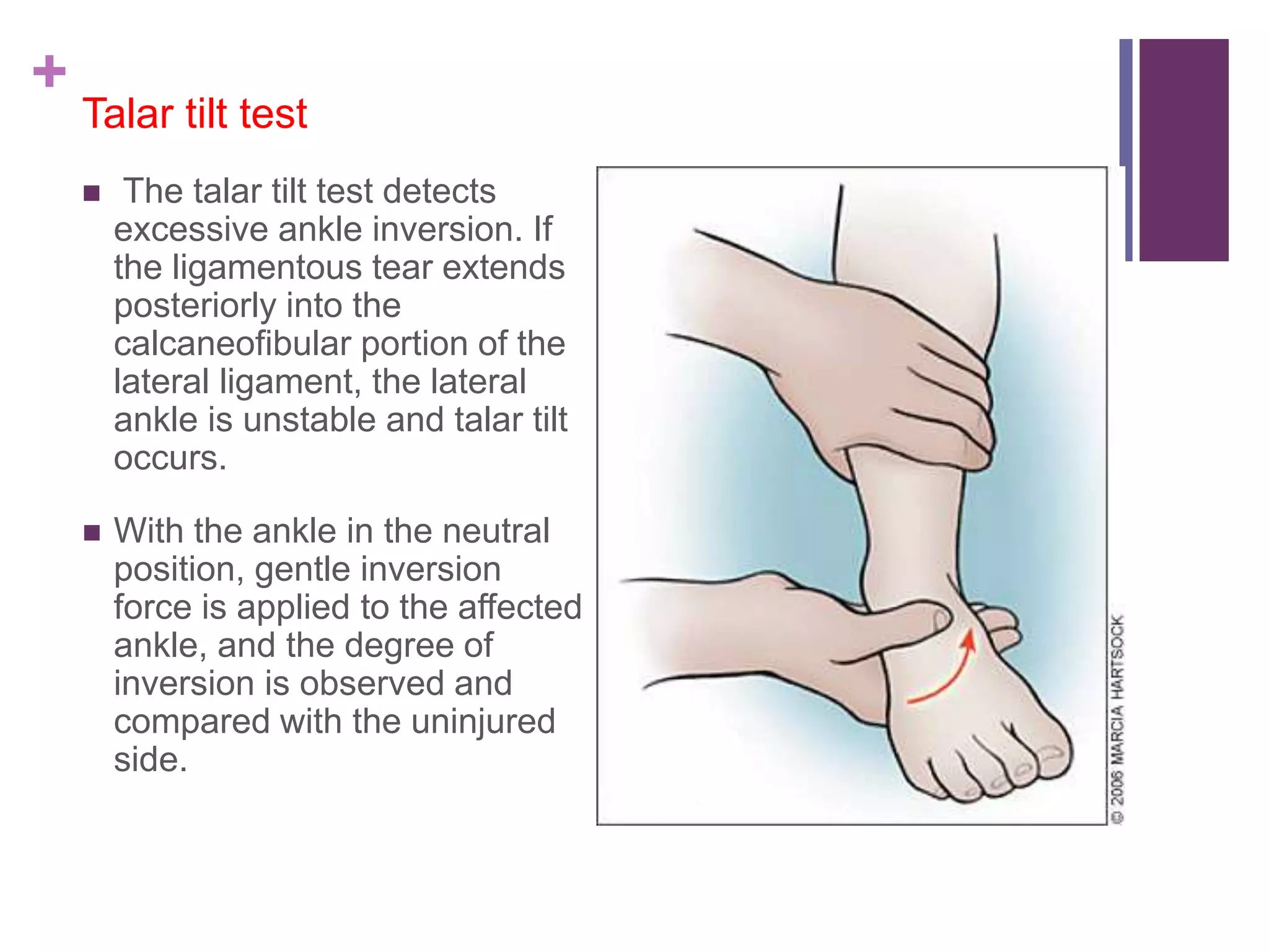 Ankle sprain | PPTX
