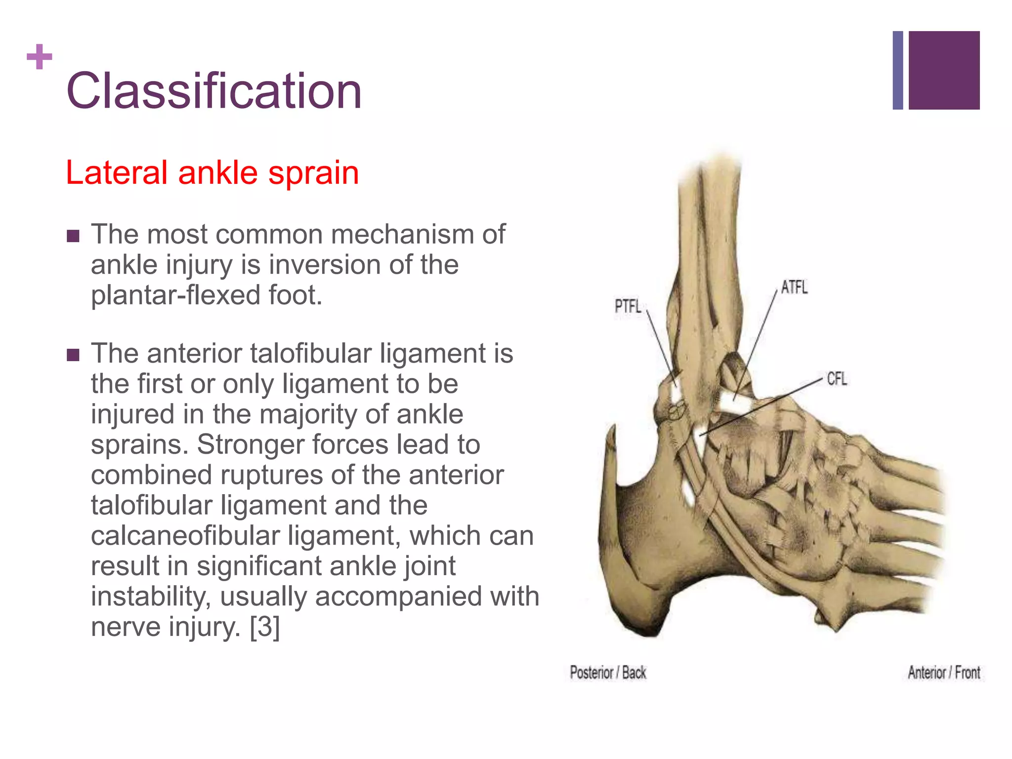 Ankle sprain | PPTX