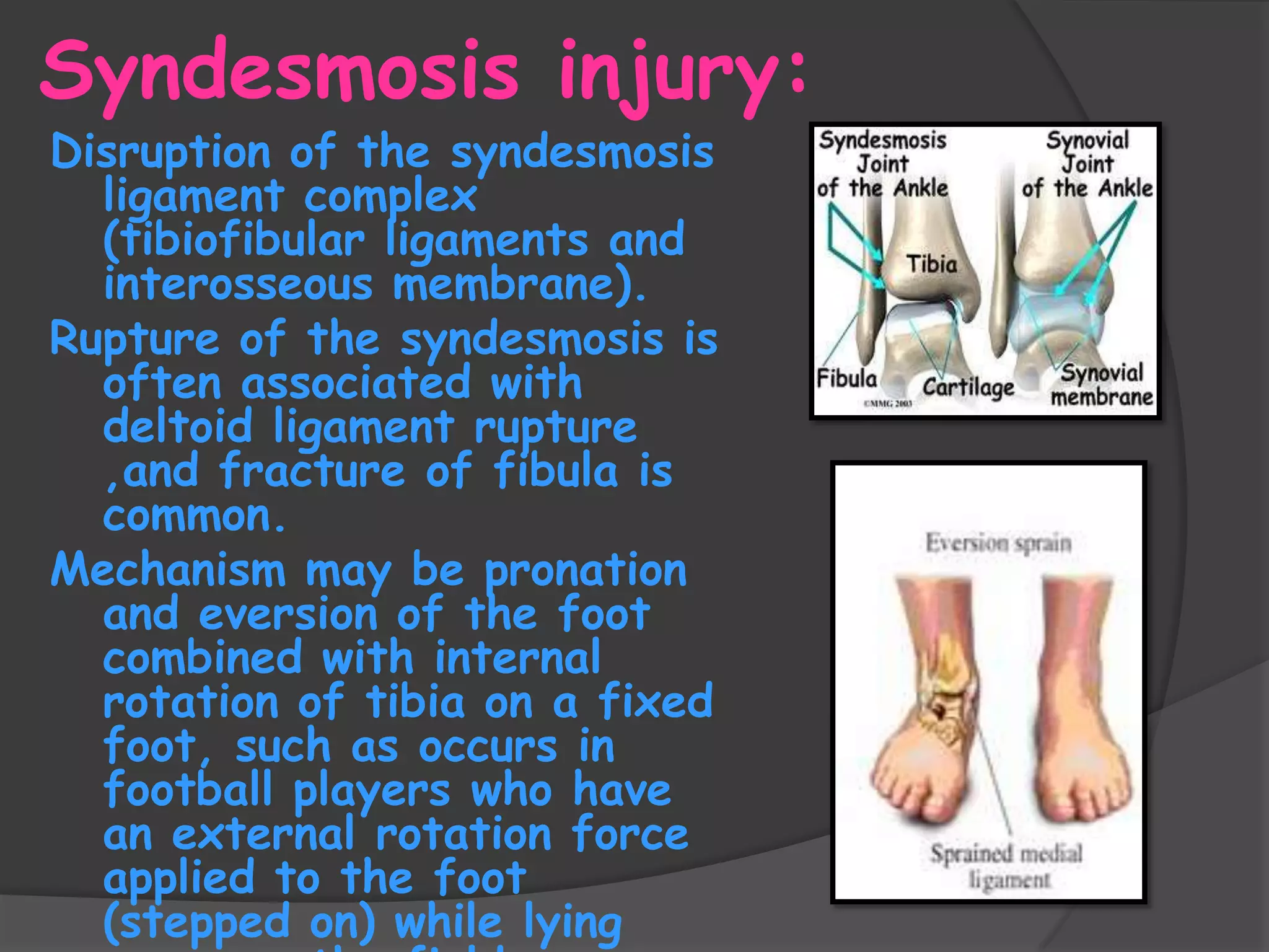Ankle Sprains | PPTX