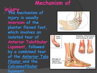 Ankle Sprain Mechanism Of Injury
