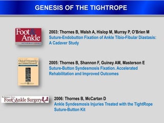 Ankle Syndesmosis TightRope | PPTX