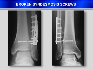 Ankle Syndesmosis TightRope | PPTX