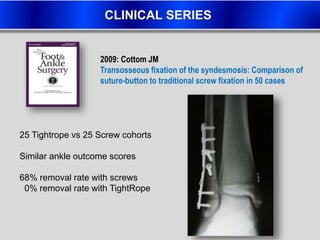 Ankle Syndesmosis TightRope | PPTX