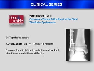 Ankle Syndesmosis TightRope | PPTX