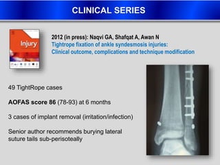 Ankle Syndesmosis TightRope | PPTX