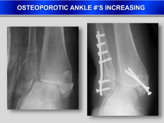 Ankle Syndesmosis TightRope | PPTX