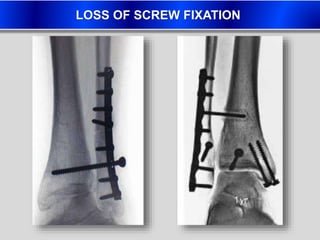 Ankle Syndesmosis TightRope | PPTX