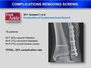 Ankle Syndesmosis TightRope | PPTX