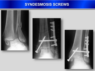 Ankle Syndesmosis TightRope | PPTX