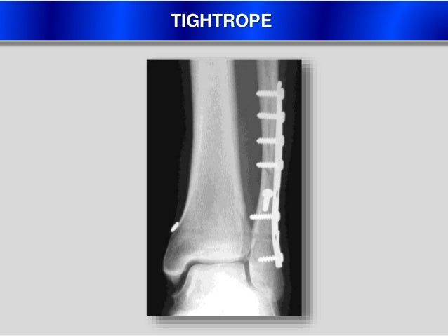 Ankle Syndesmosis TightRope