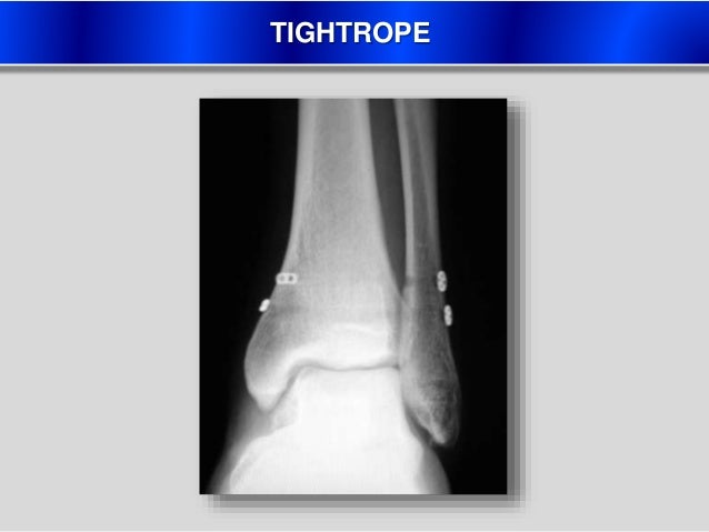 Ankle Syndesmosis TightRope