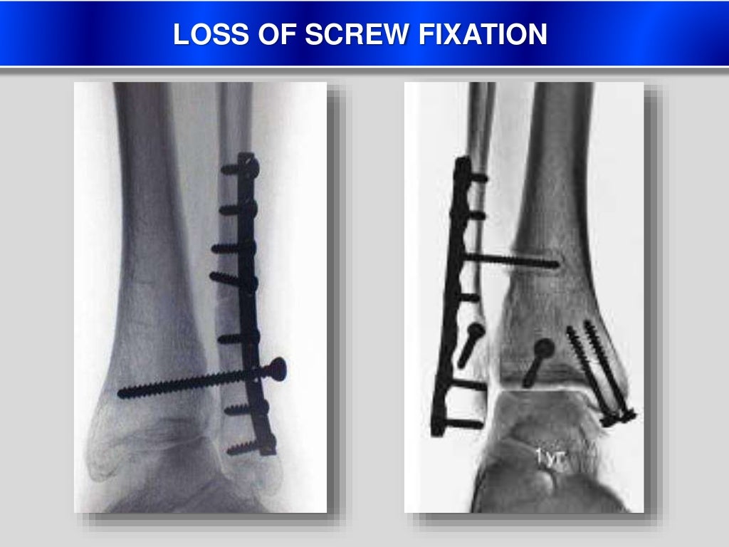 Ankle Syndesmosis TightRope