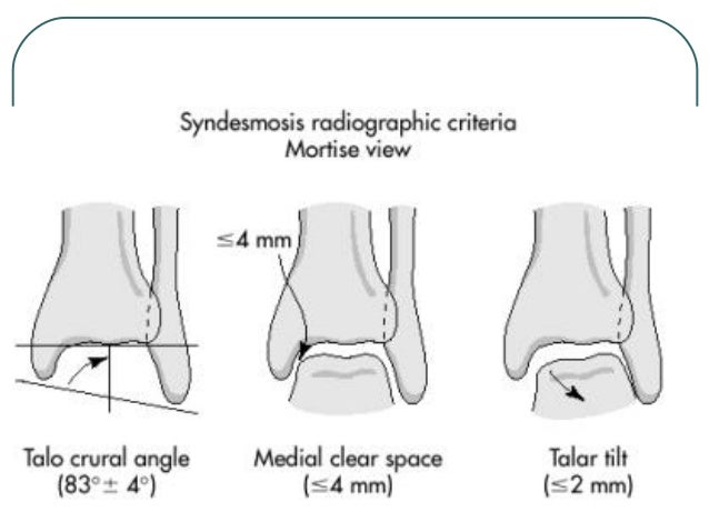 Ankle xrays