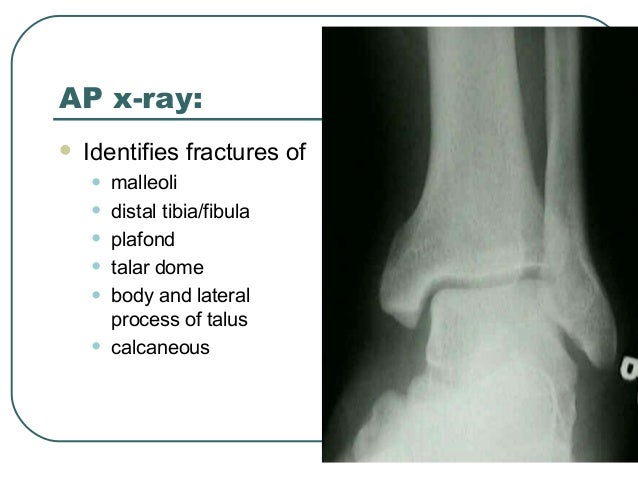 X Ray Ankle Dislocation Medworldonline