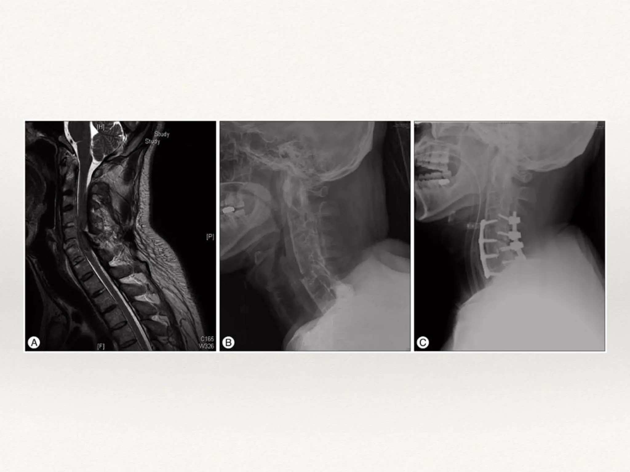Ank spond cervical injury ppt | PPT