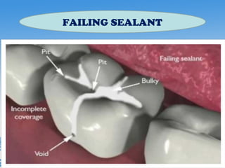 PIT AND FISSURE SEALANTS- PUBLIC HEALTH DENTISTRY | PPT