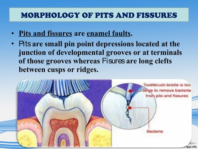 PIT AND FISSURE SEALANTS- PUBLIC HEALTH DENTISTRY | PPT