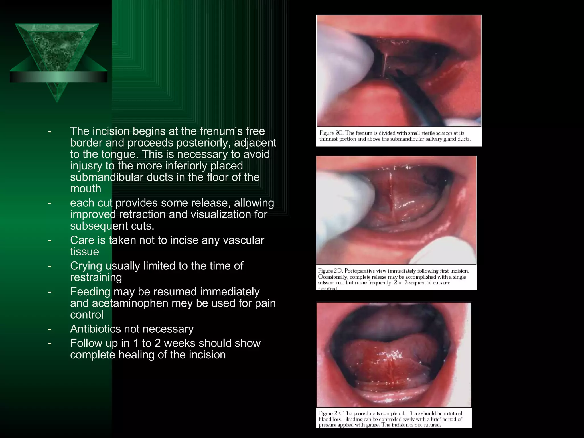 Ankyloglossia (Tongue-tie) | PPT