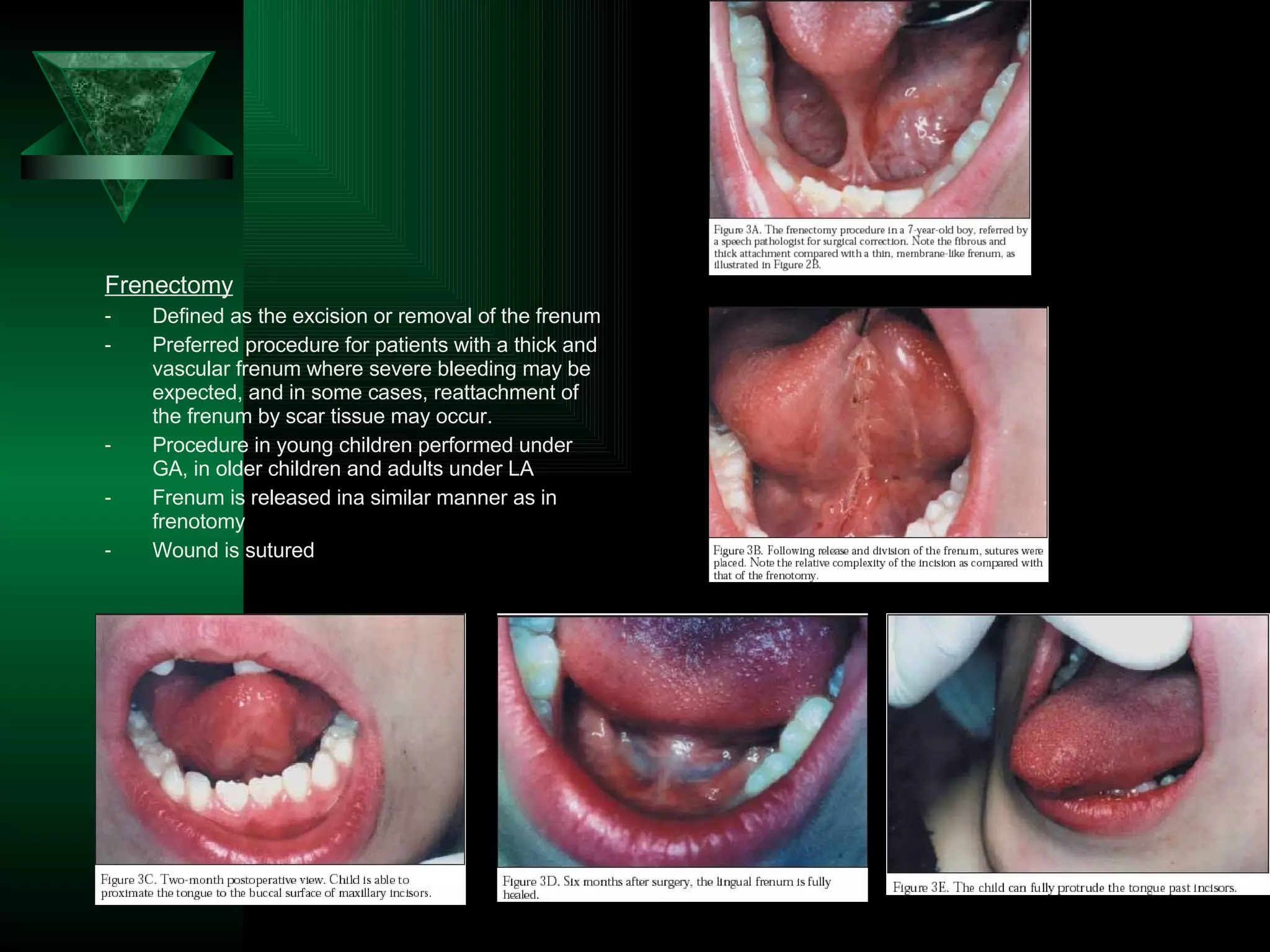 Ankyloglossia (Tongue-tie) | PPT