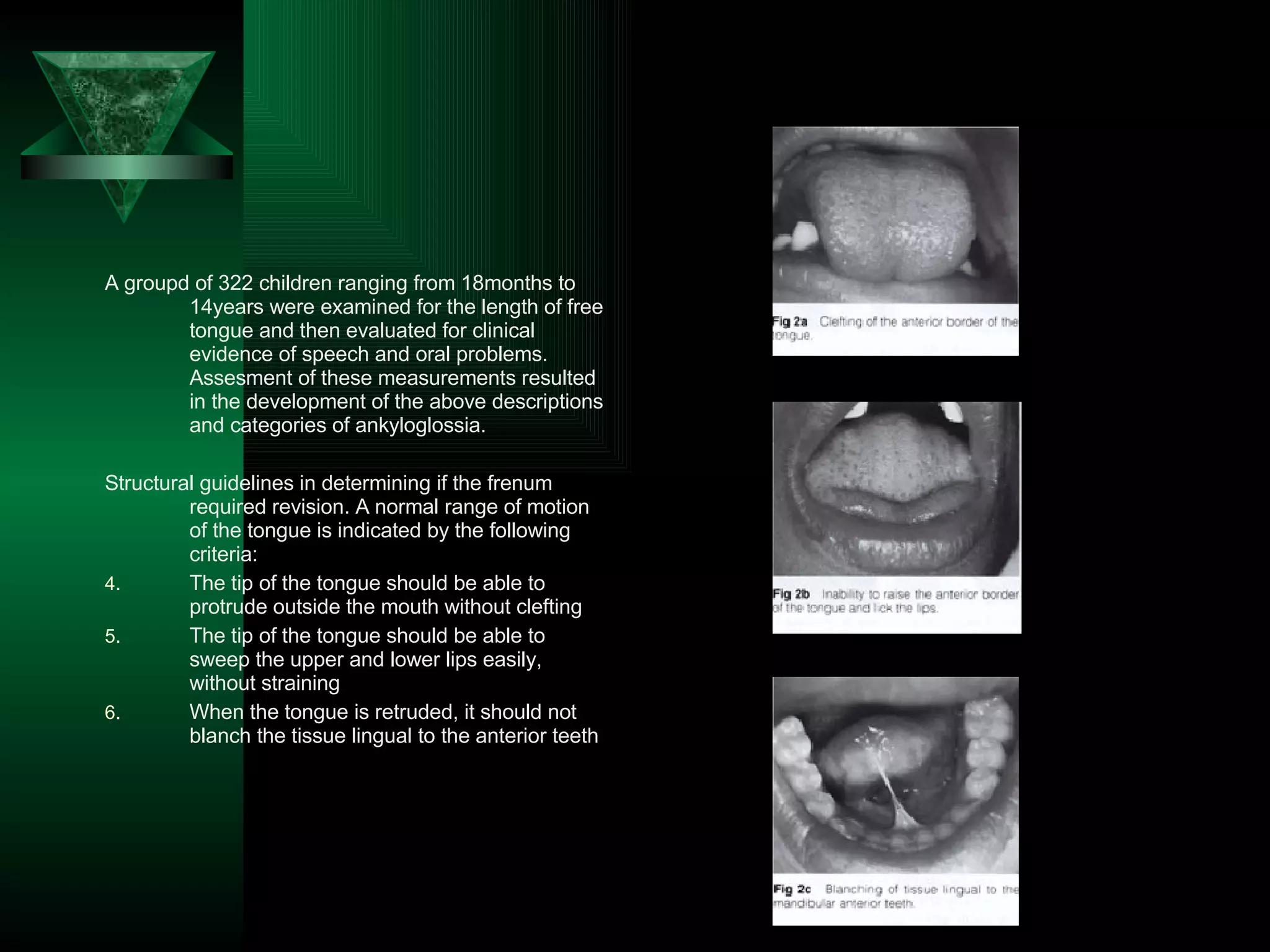 Ankyloglossia (Tongue-tie) | PPT