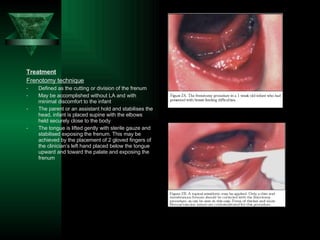 Ankyloglossia (Tongue-tie) | PPT