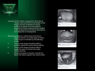 Ankyloglossia (Tongue-tie) | PPT