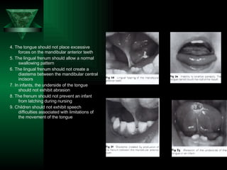 Ankyloglossia (Tongue-tie) | PPT