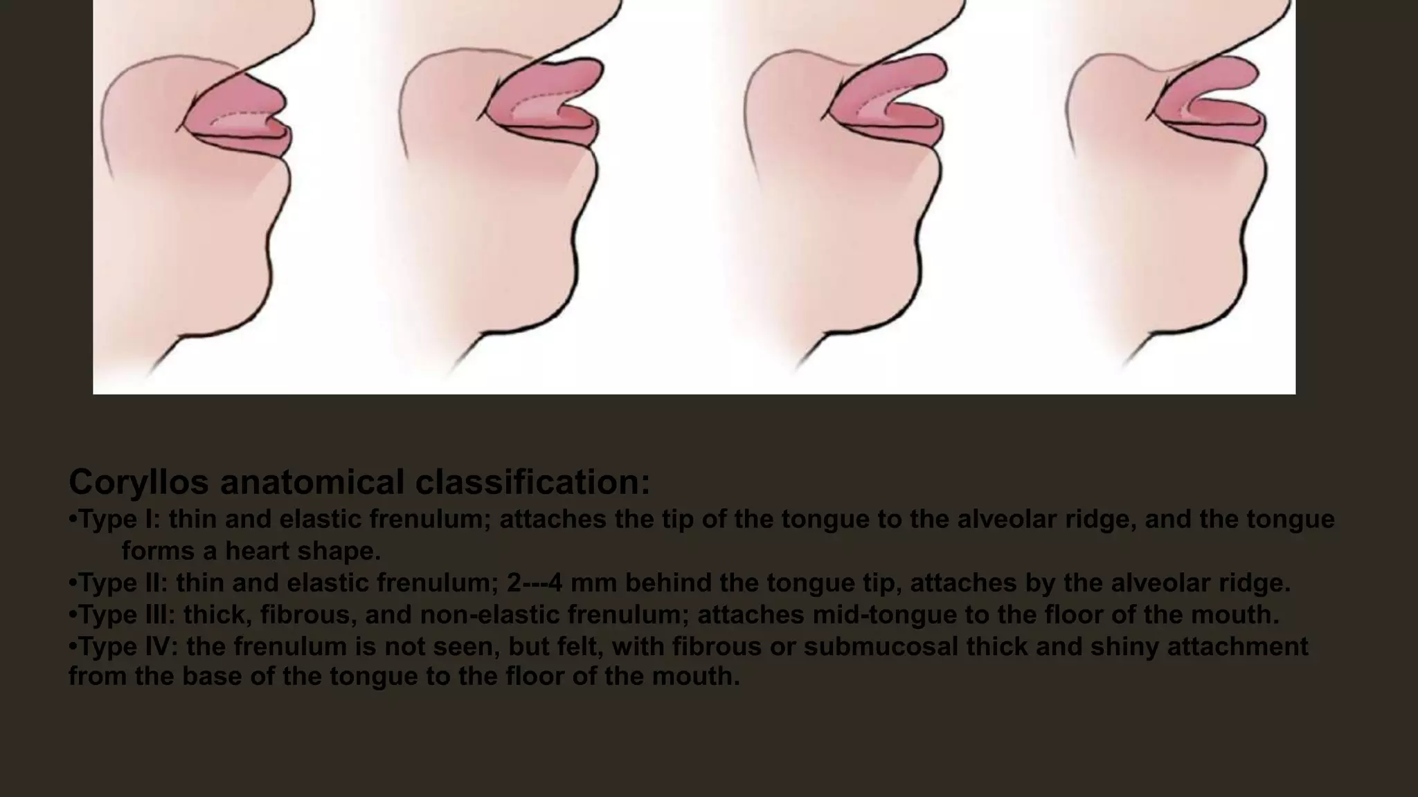 Ankyloglossia cp | PPTX
