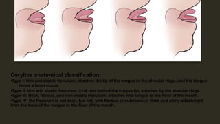Ankyloglossia cp | PPTX | Ear, Nose and Throat Conditions | Diseases ...