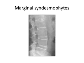 Ankylosing spondilitis | PPTX