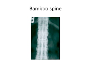 Ankylosing spondilitis | PPTX