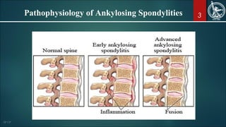 Ankylosing spondylities | PPT