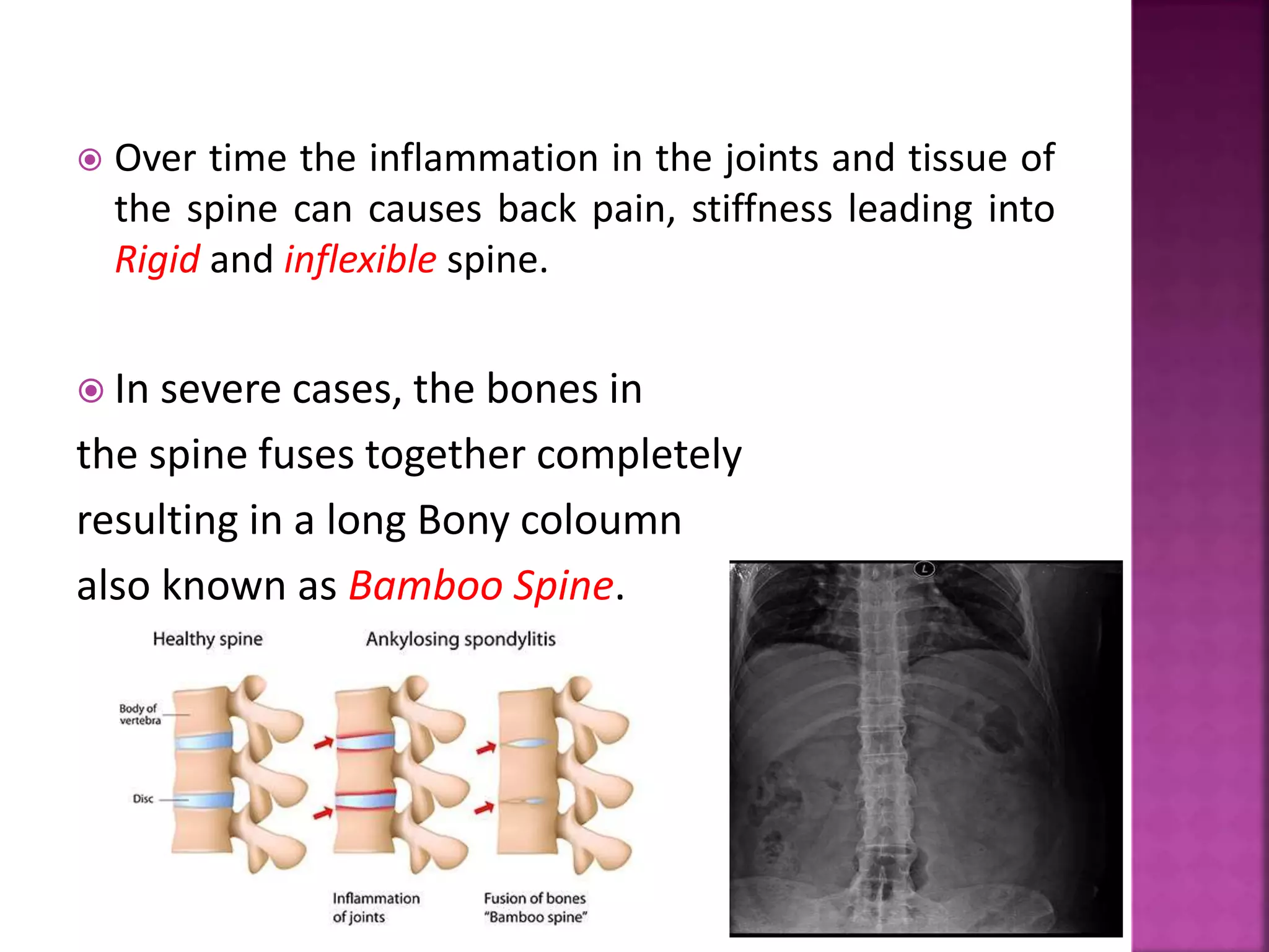 ANKYLOSING SPONDYLITIS-1.pptx