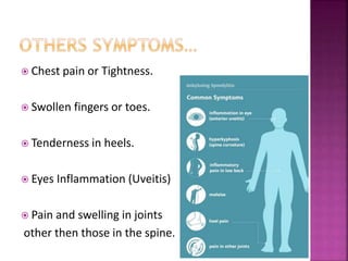 ANKYLOSING SPONDYLITIS-1.pptx