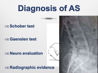 Ankylosing spondylitis | PPTX