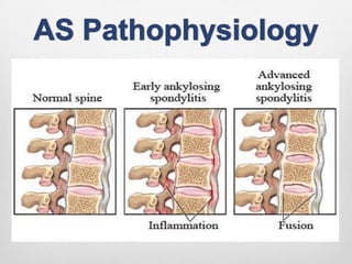 Ankylosing Spondylitis Pptx