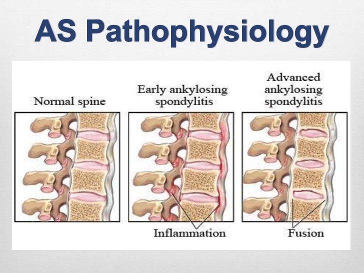 Ankylosing spondylitis