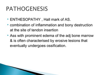 Ankylosing spondylitis | PPT