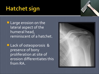 Ankylosing spondylitis | PPT