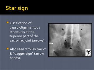 Ankylosing spondylitis | PPT