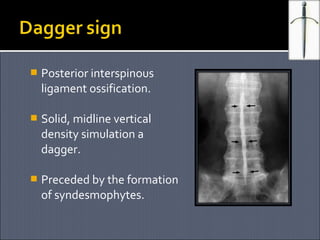 Syndesmophytes Ankylosing Spondylitis