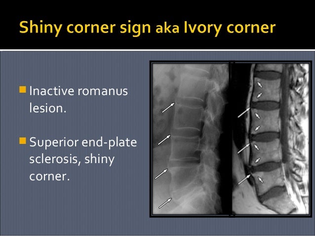 Ankylosing spondylitis