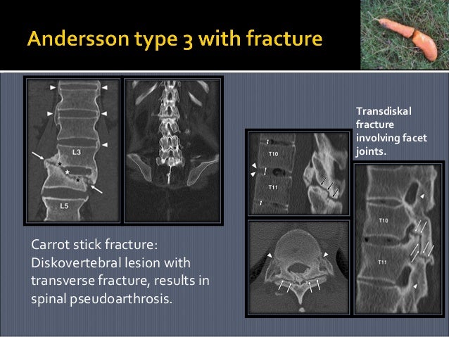 Ankylosing spondylitis