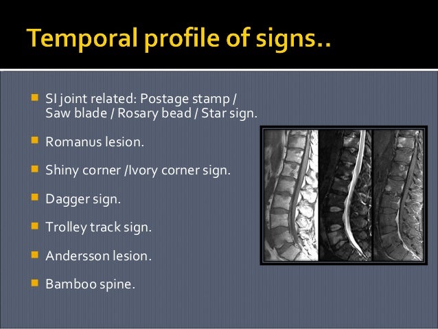 Ankylosing spondylitis