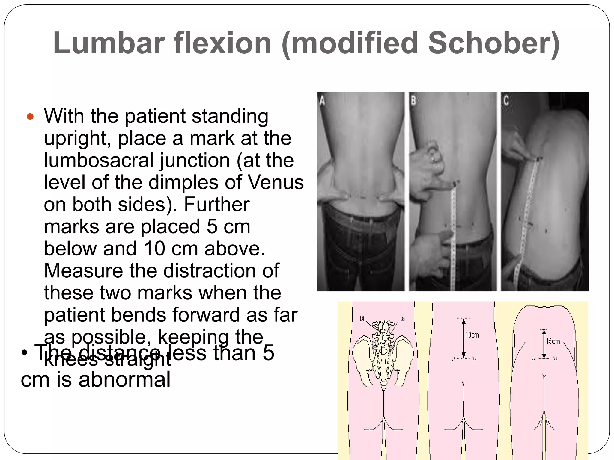 Ankylosing spondylitis. (ben) | PPTX